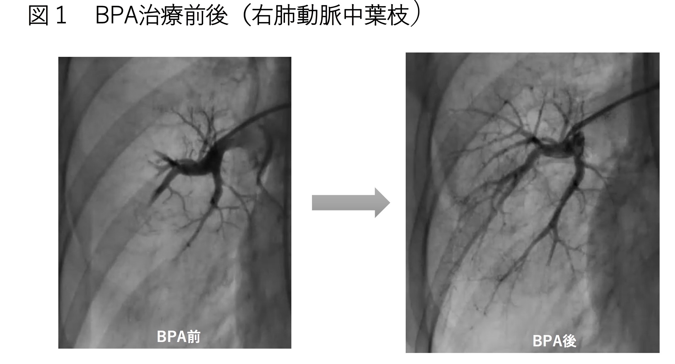 慢性血栓塞栓性肺高血圧症（CTEPH）に対する肺動脈拡張術（BPA） | 名古屋大学附属病院ハートチーム